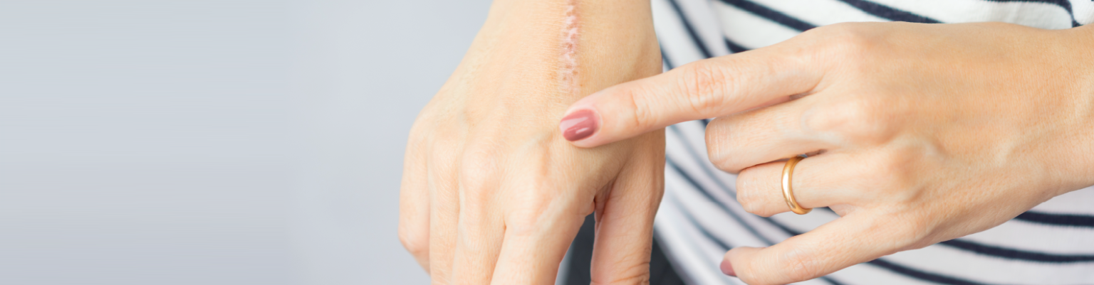 Hand Scar Care North Shore | Hypertrophic Scar Treatment