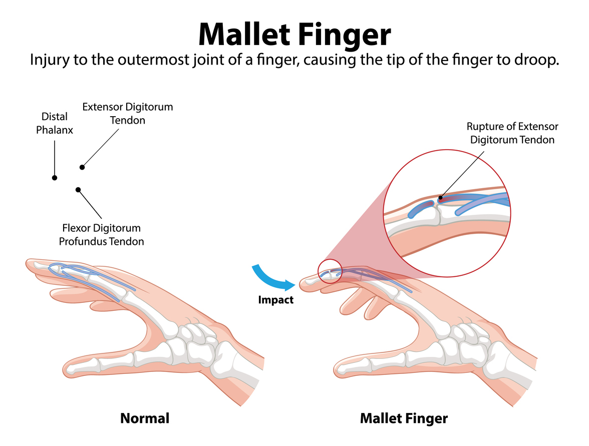 Mallet Finger Treatment North Shore, Sydney