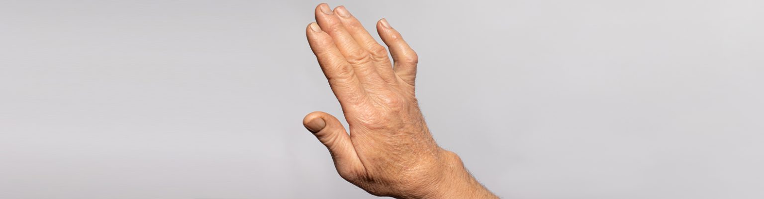 Thumb Arthritis Treatment North Shore | Hand Therapy Experts